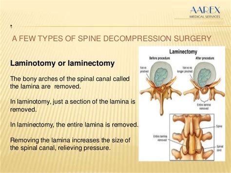 Spine Decompression Surgery