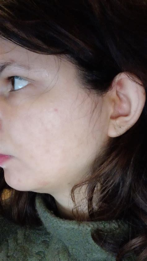 One Month Difference What Do You Think I Struggle With Slight Traces