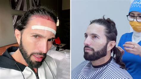 Poncho De Nigris Se Coloca Injerto De Cabello Y Luce Irreconocible Lo Comparan Con Sebastián