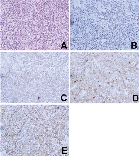 Case 2 Photomicrographs Of The Resected Tumor Revealing The Tumor