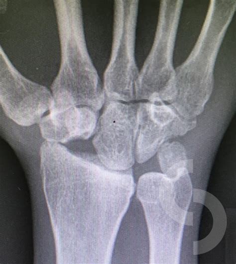 Proximal Row Carpectomy Dr Sonja Cerovac