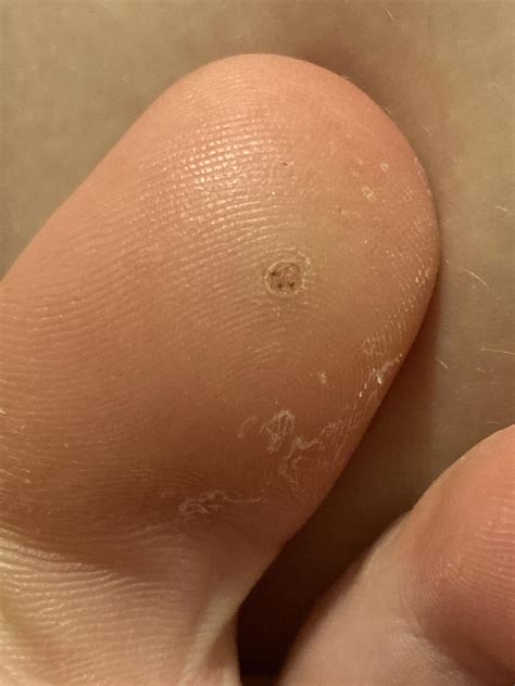 Is This A Plantars Wart Or No I Dont Really Want To Go To The Doctor