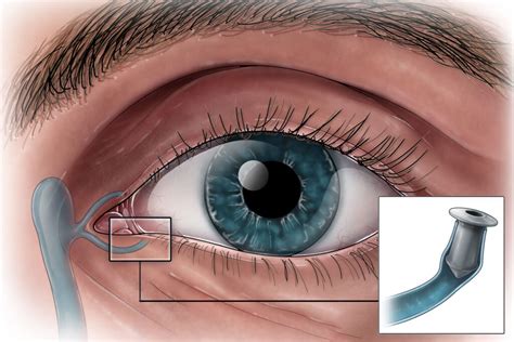 Dry Eye Solutions How Punctal And Silicone Plugs Can Help Dr Amit Jain Dubai