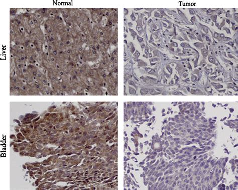 Expression Of Gpi8 Protein In Matched Normal And Tumor Tissues From