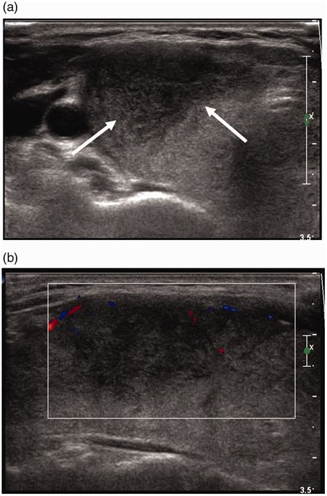 A Case Of Nontuberculous Mycobacteria Associated Thyroiditis Mimicking Subacute Thyroiditis Pmc