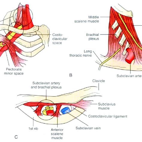 Pdf Pectoralis Minor Syndrome Subclavicular Brachial Plexus Compression