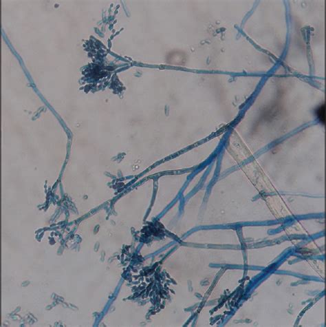 A Rare Case Of Phaeohyphomycosis Caused By Fonsecaea Pedrosoi In A