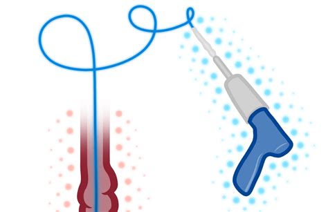 Benefits of Venaseal - Delaware Vein Center