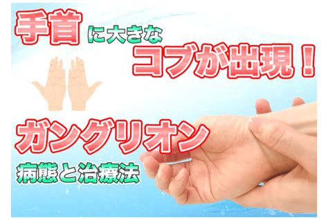 手首に大きなコブが出現ガングリオンの病態と治療法を解説伊勢崎市の接骨院がく整骨院針灸整体院夜21時まで予約受付
