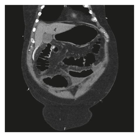 Ct Abdomen Showing Extravasation Of Contrast Material Download Scientific Diagram