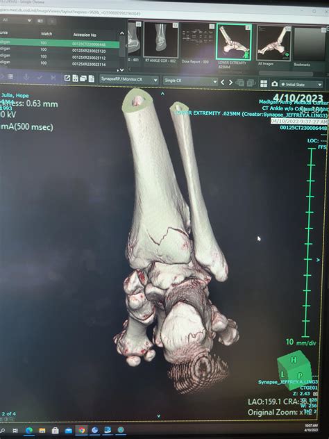 I Broke My Tibia In 2 Places Today On My Ankle Side And The Back R