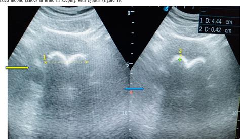 Figure 1 From Urinary Bladder Calculus In An Adult Male Patient Presenting With Obstructive