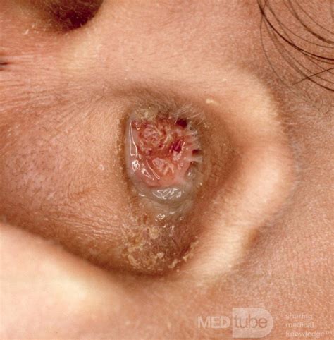 Large Aural Polyp • Image •