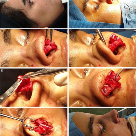 A Nasal Axis Deviation Nad From Midline In This 28 Year Old Man