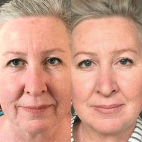 Ultrassom Microfocado Antes E Depois Palladium Estética