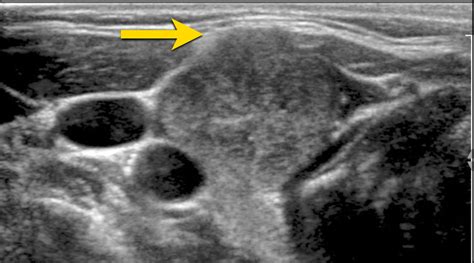The Radiology Assistant Ti Rads Thyroid Imaging Reporting And Data