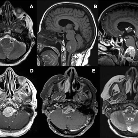 Brain Mri A Axial T2 Weighted Sequences Show A Right Paramedian Mass