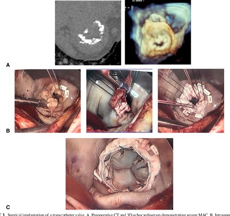 Figure 1 From Current Techniques For Severe Mitral Annular