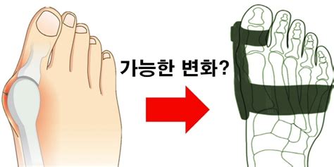 ‘무지외반증 수술 대신 교정기 치료 실제 교정효과는