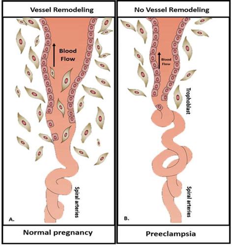 Preeclampsia From Etiopathology To Organ Dysfunction Intechopen