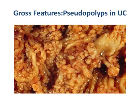 Histology Of Ibd Pptx