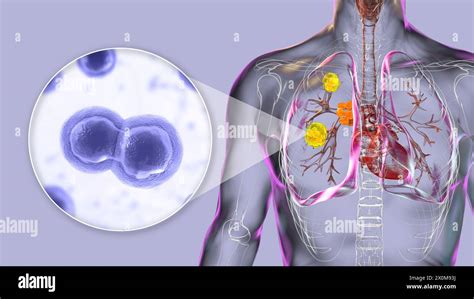 3d Illustration Of Pulmonary Blastomycosis And A Close Up Of The Causative Fungus Blastomyces