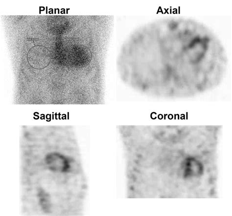 99mtc Bone Avid Tracer Cardiac Scintigraphy Role In Noninvasive Diagnosis Of Transthyretin
