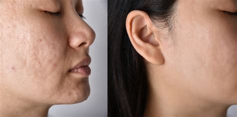 How I Cleared My Acne Naturally Skincare And Wellness Guide Nabhi Sutra