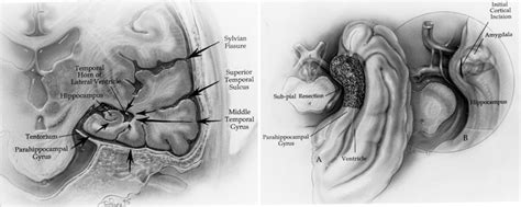 Middle Temporal Sulcus