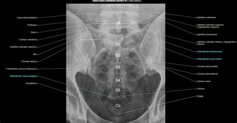 Radiografía De La Articulación Sacroilíaca Normal