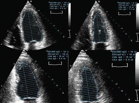 Echocardiogram Congestive Heart Failure