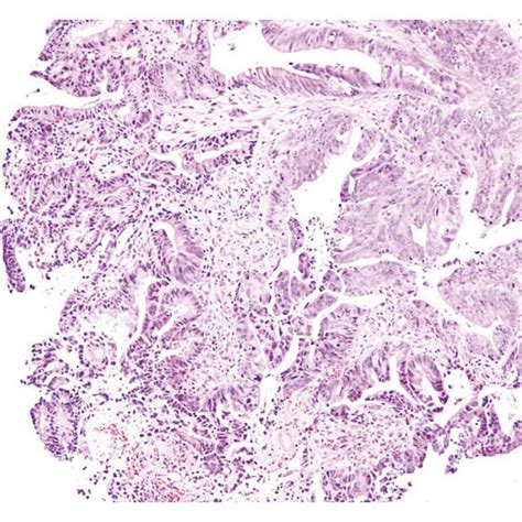 A Upper Gastrointestinal Endoscopy Findings A Type 1 Tumor With A