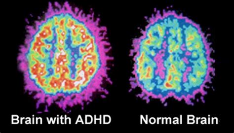 Attention Deficit Disorder Brain Compared To Normal Brain