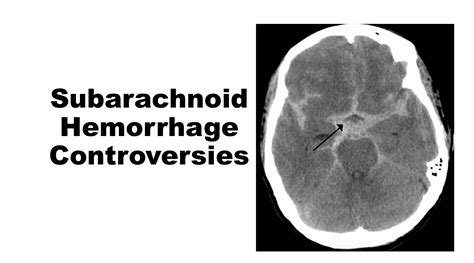 Controversies In The Diagnosis Of Subarachnoid Hemorrhage Emdocs