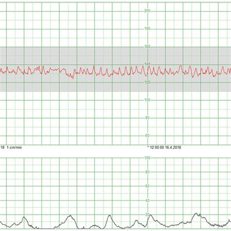 cardiotocography tracing demonstrating transient pseudo‐sinusoidal