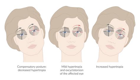 Trochlear Nerve Palsy