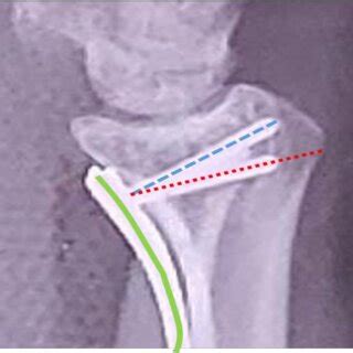 Plate Design Allows Support Of Subchondral Bone At Lunate Fossa By Two