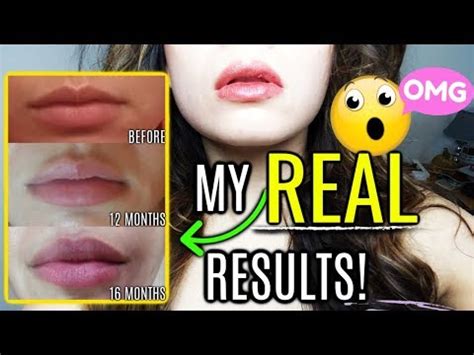 How To Get Bigger Lips Permanently Without Surgery Follow 7 Steps