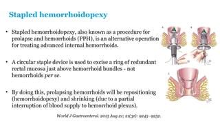 Current Practices Of Common Anorectal Disorders Pptx