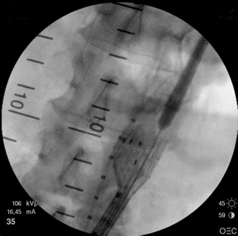 Thoracoscopic Pericardial Window CTSNet