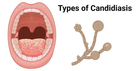 Cutaneous Candidiasis Causes