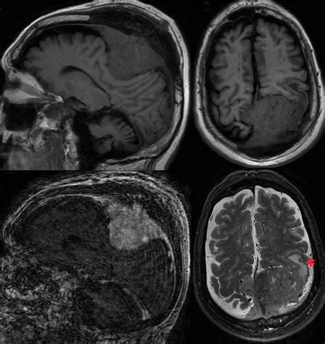 4d Cta And Preoperative Embolization Of Large Intraosseous Meningioma