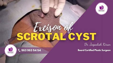 Scrotal Sebaceous Cysts Treatment In Hyderabad Scrotal Sebaceous