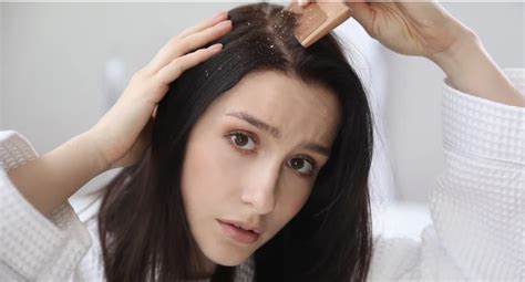 Top 5 Over The Counter Products For Fungal Scalp And Skin Problems