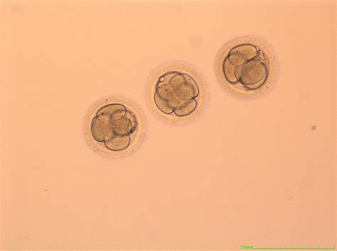 ICSI Treatment At Affordable Cost Corion Fertility Clinic