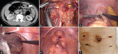 Laparoscopic Radical Transverse Colectomy With Transrectal S