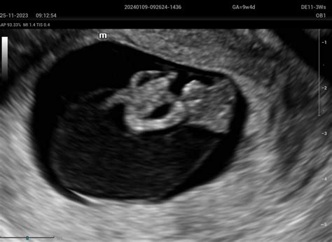 Ultrasound Journal 30 Fetal Body Stalk Anomaly Diagnosis Mindray