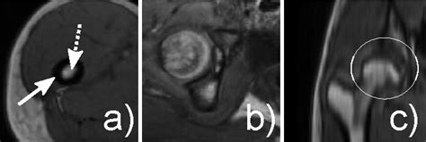 Figure 1 From Robust Statistical Shape Models For Mri Bone Segmentation In Presence Of Small