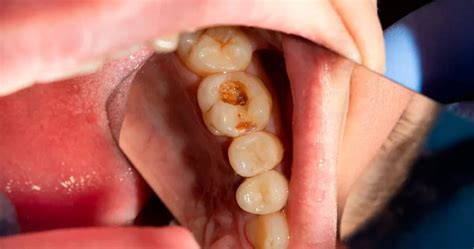 Caries Dental Síntomas y Riesgos Clínica Dental Tacna