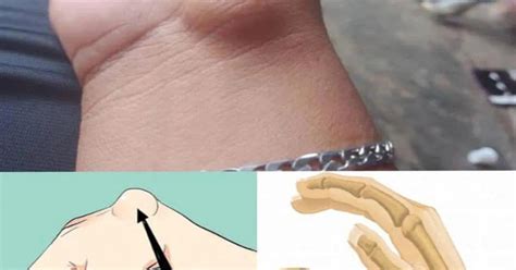 Wrist Ganglion Causes Symptoms And Effective Treatments Yohanpost